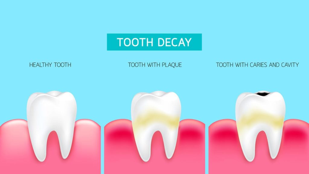 Tooth Decay Process In Adults & Young Children | Dentist Harrisburg NC