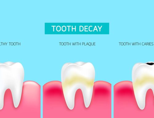 Pediatric Tooth Decay: Causes, Treatment & Prevention | Dentist ...