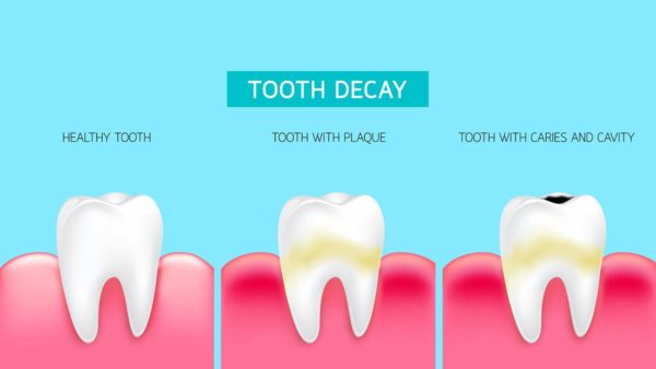 Tooth Decay Process In Adults & Young Children | Dentist Harrisburg NC