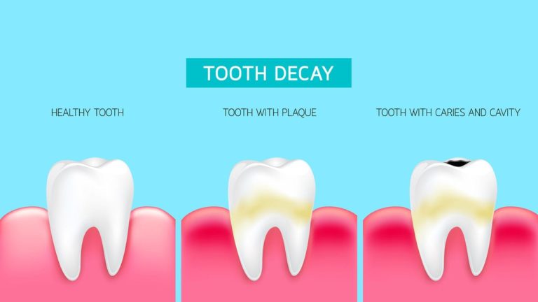 Tooth Decay Process In Adults & Young Children | Dentist Harrisburg NC