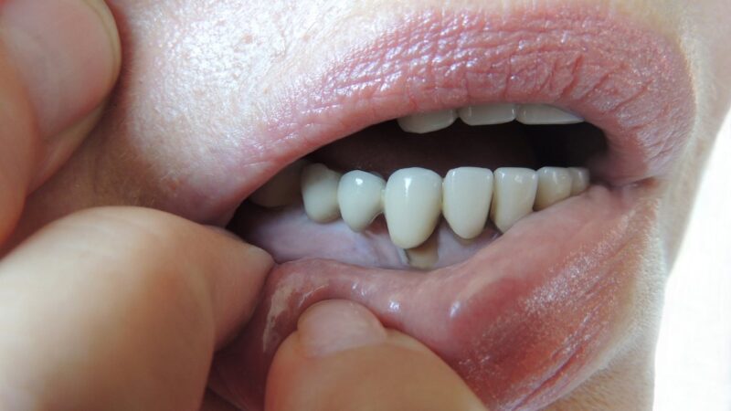 Orthodontic Treatment for Severe Stage IV Periodontitis