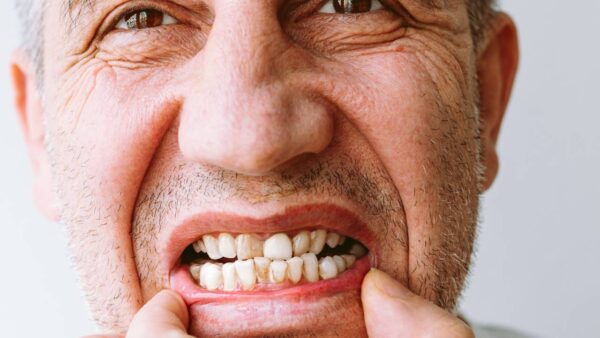 Can You Scrape Tartar Off at Home? | Harrisburg Family Dentist